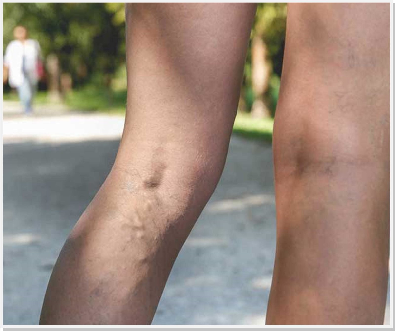 Você sabia que mais de 50% dos adultos têm varizes? - Cirurgião Vascular